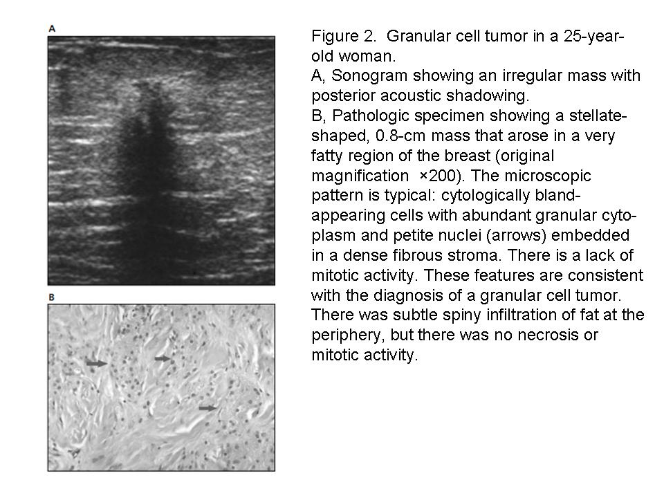 BÀI SOẠN VỀ SIÊU ÂM CHẨN ĐOÁN: Posterior Acoustic Shadowing in Benign ...
