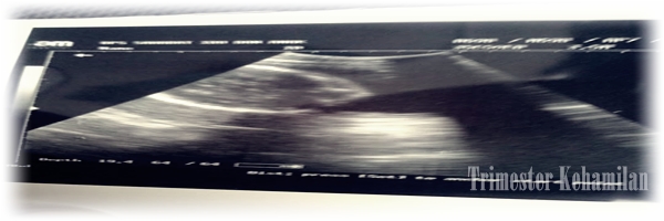 Penjelasan Lengkap Mengenai Kehamilan Ektopik Atau Luar Kandungan ...