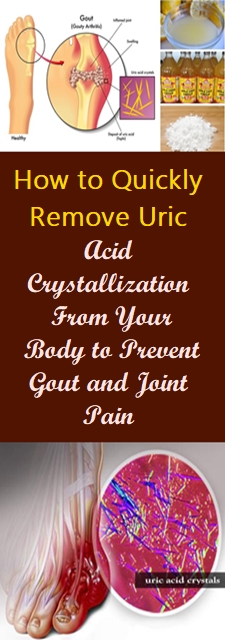 How to Quickly Remove Uric Acid Crystallization From Your Body to ...