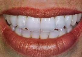 Gek van zichzelf: Het perfecte gebit