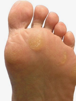 Tratamiento spa para los callos y durezas de los pies ~ Belleza y Peinados