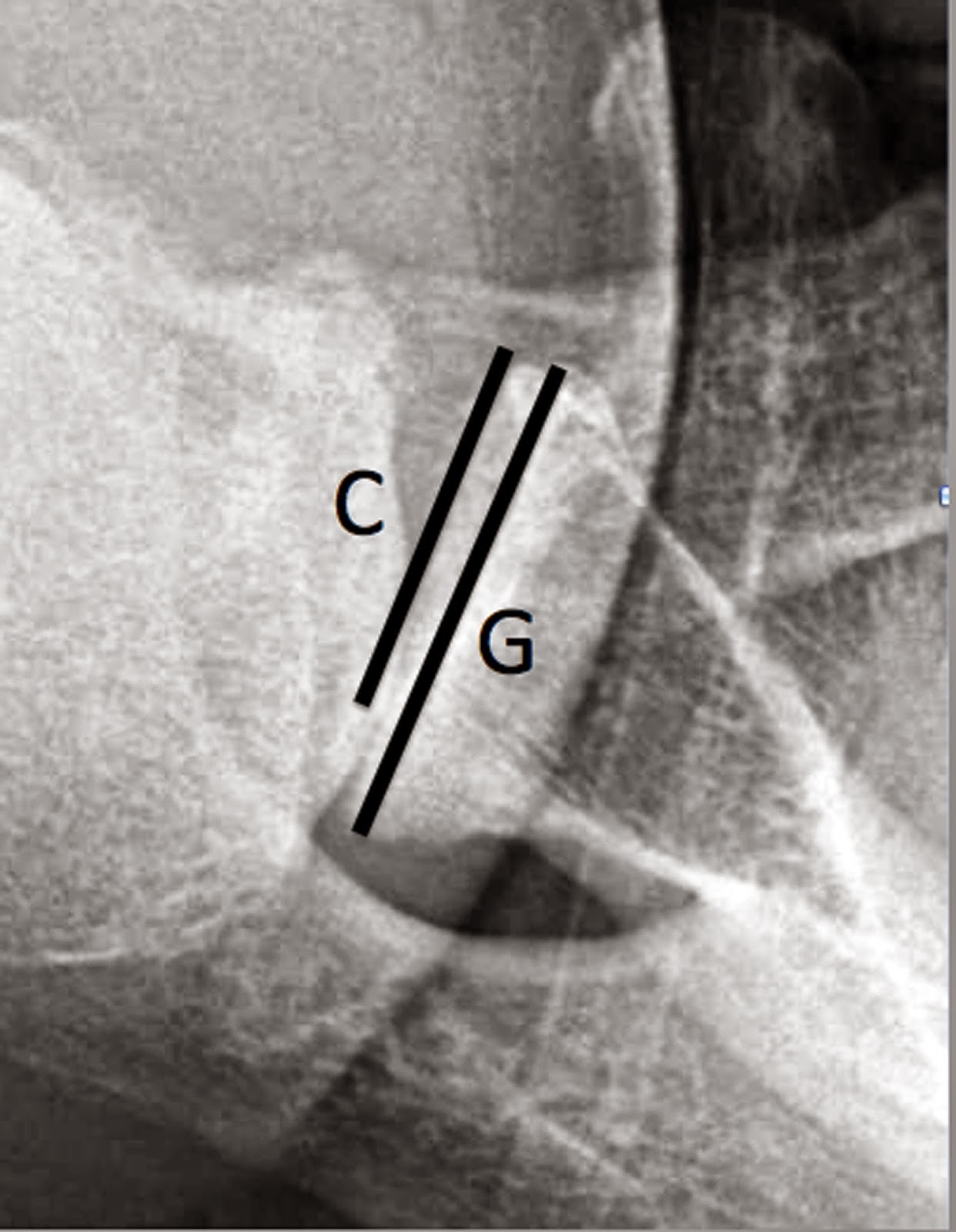 UW Shoulder and Elbow Academy: Posterior glenoid wear, glenoid ...