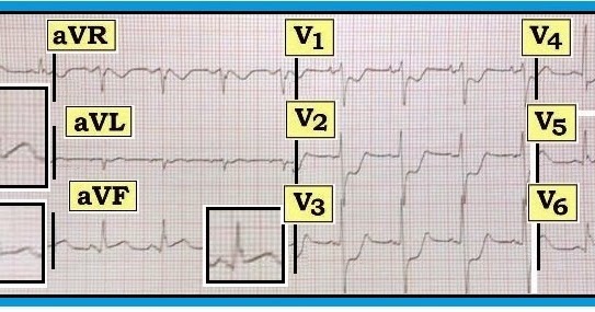 ECG Interpretation: ECG Interpretation Review #80 (Acute STEMI – RCA vs ...