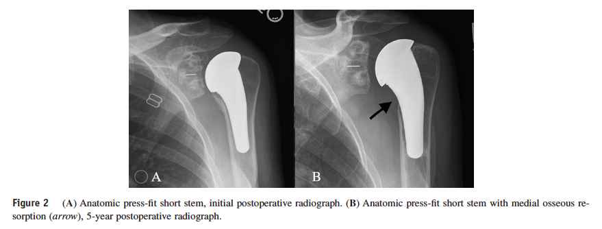 Shoulder Arthritis / Rotator Cuff Tears / Shoulder Pain : Short humeral ...