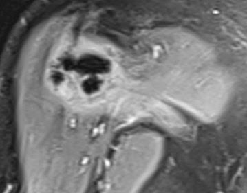 RADIODIAGNOSIS - IMAGE COLLECTION: MILWAUKEE SHOULDER