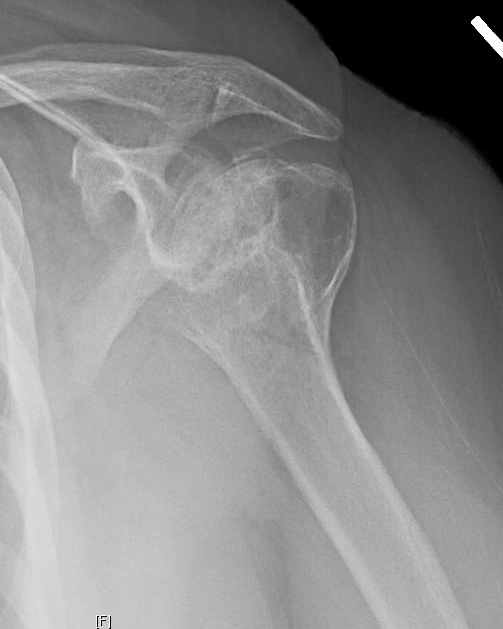 UW Shoulder and Elbow Academy: The versatility of a standard humeral ...