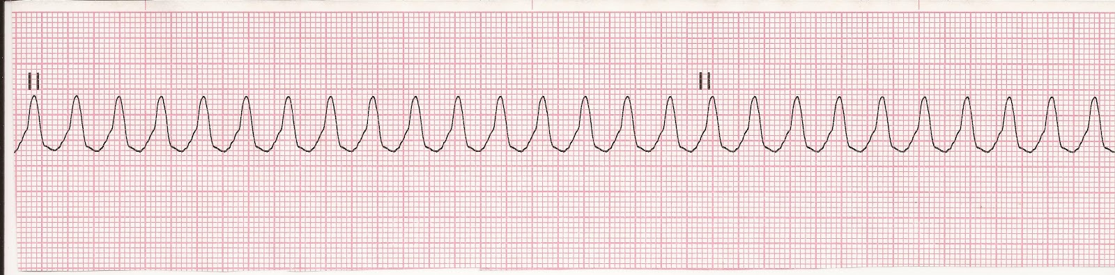 Pediatric Advance Life Support: SVT Part 3