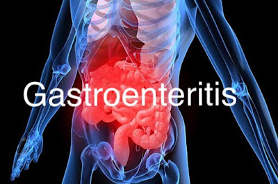 Gastroenteritis: Types, Symptoms, Causes and Treatments - Health Nigeria