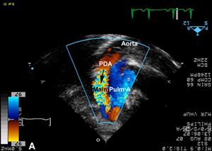 MEDI LEARNER: PATENT DUCTUS ARTERIOSUS (PDA)