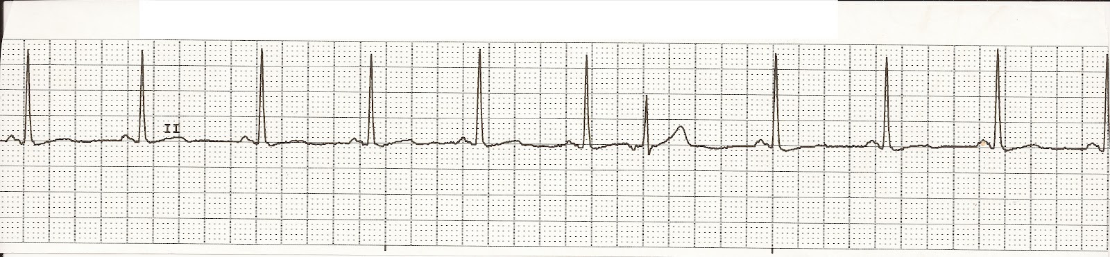 EKG Rhythm Strip Quiz 57: Ectopic Beats