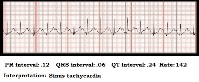 ECG Rhythm Strip Quiz 101: Interval measurements