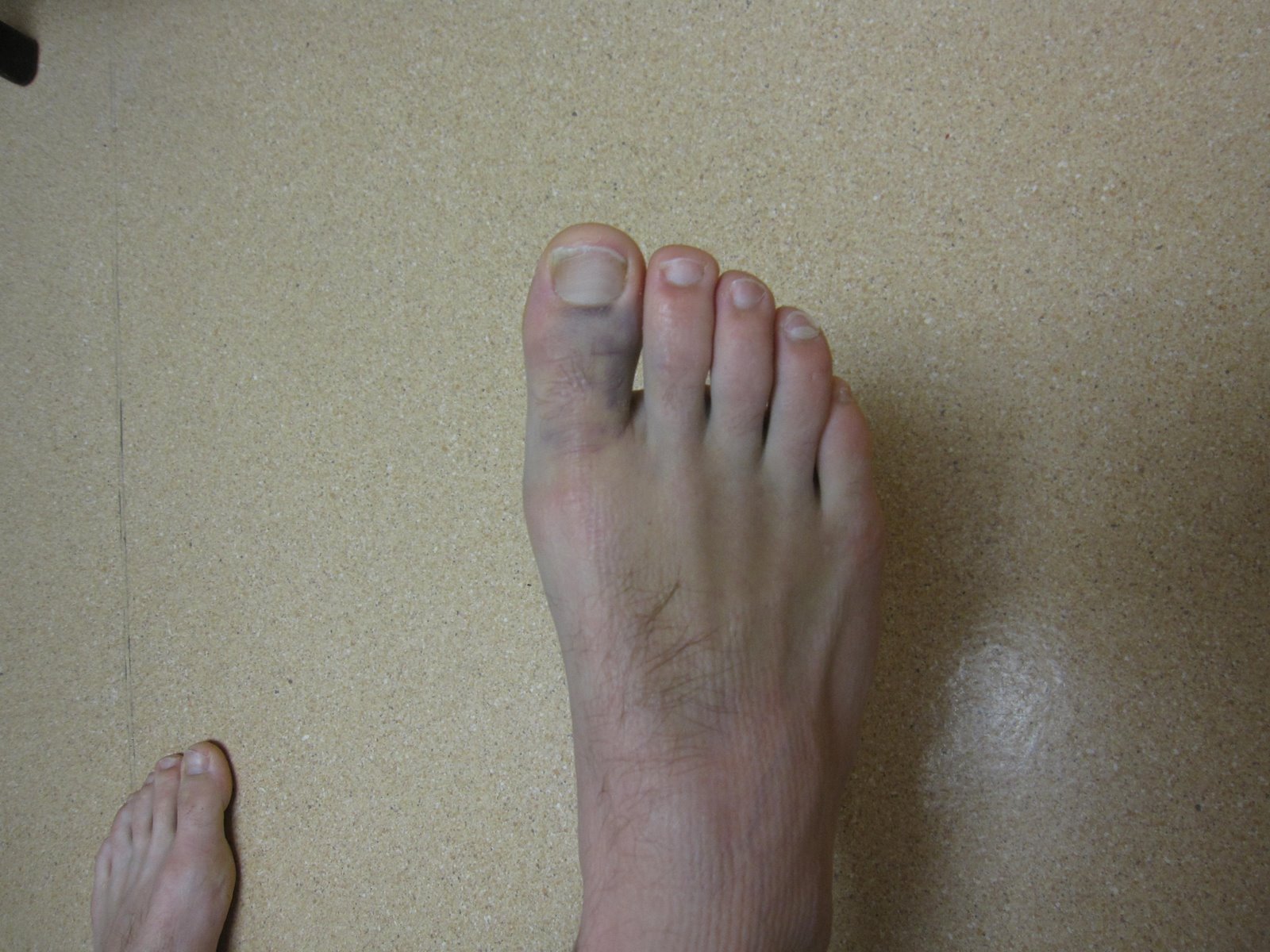 BrOwN fAmiLY: Broken Toe