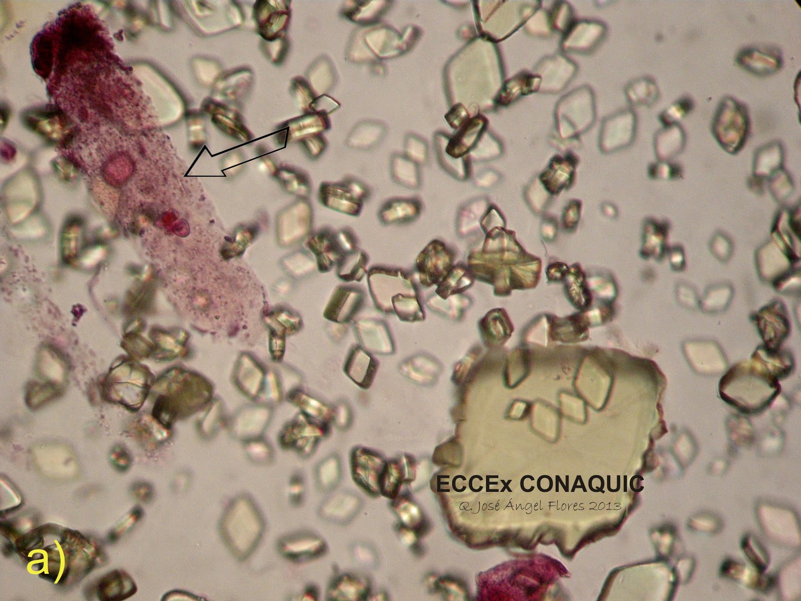 Caso UR- marzo-13 (Enfoque: cristaluria)