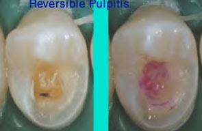 hiphoplife: Reversible Pulpitis