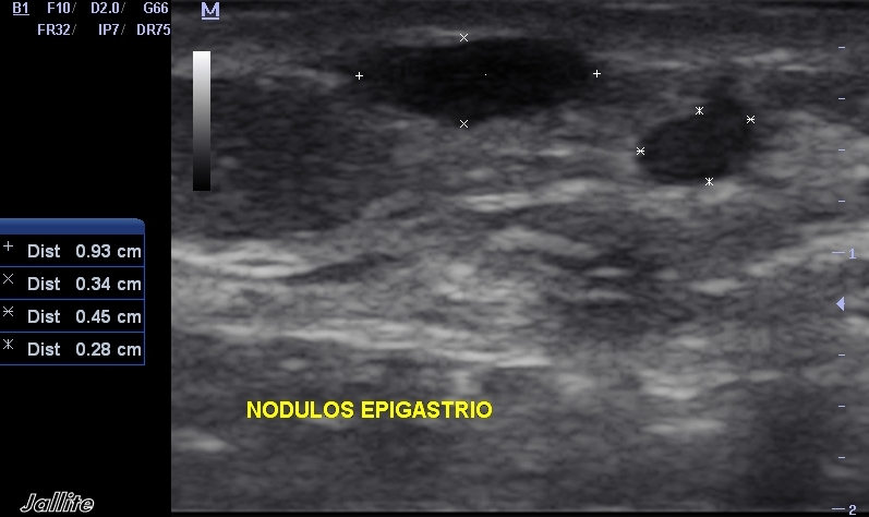 Abscesos Multiples Pared Abdominal I