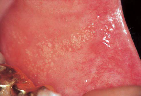 Healthy Ranula: White Lesions of Oral Mucosa
