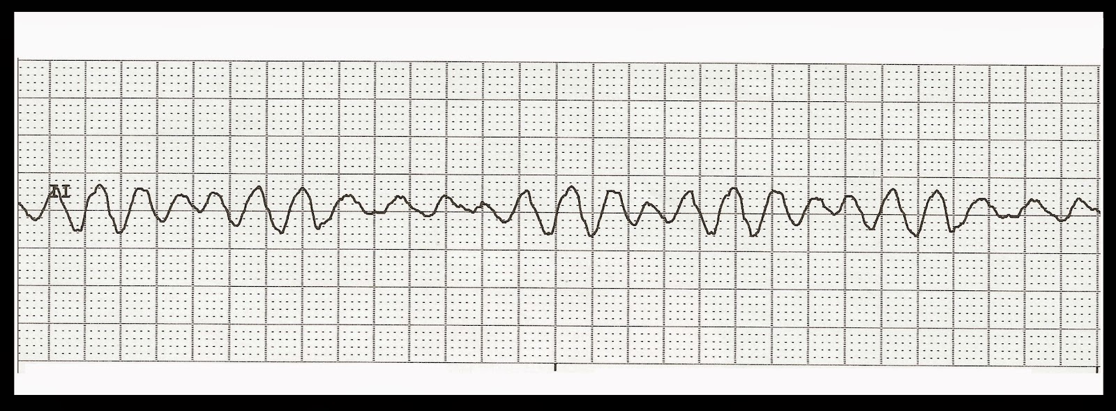 Practice EKG Strips 423