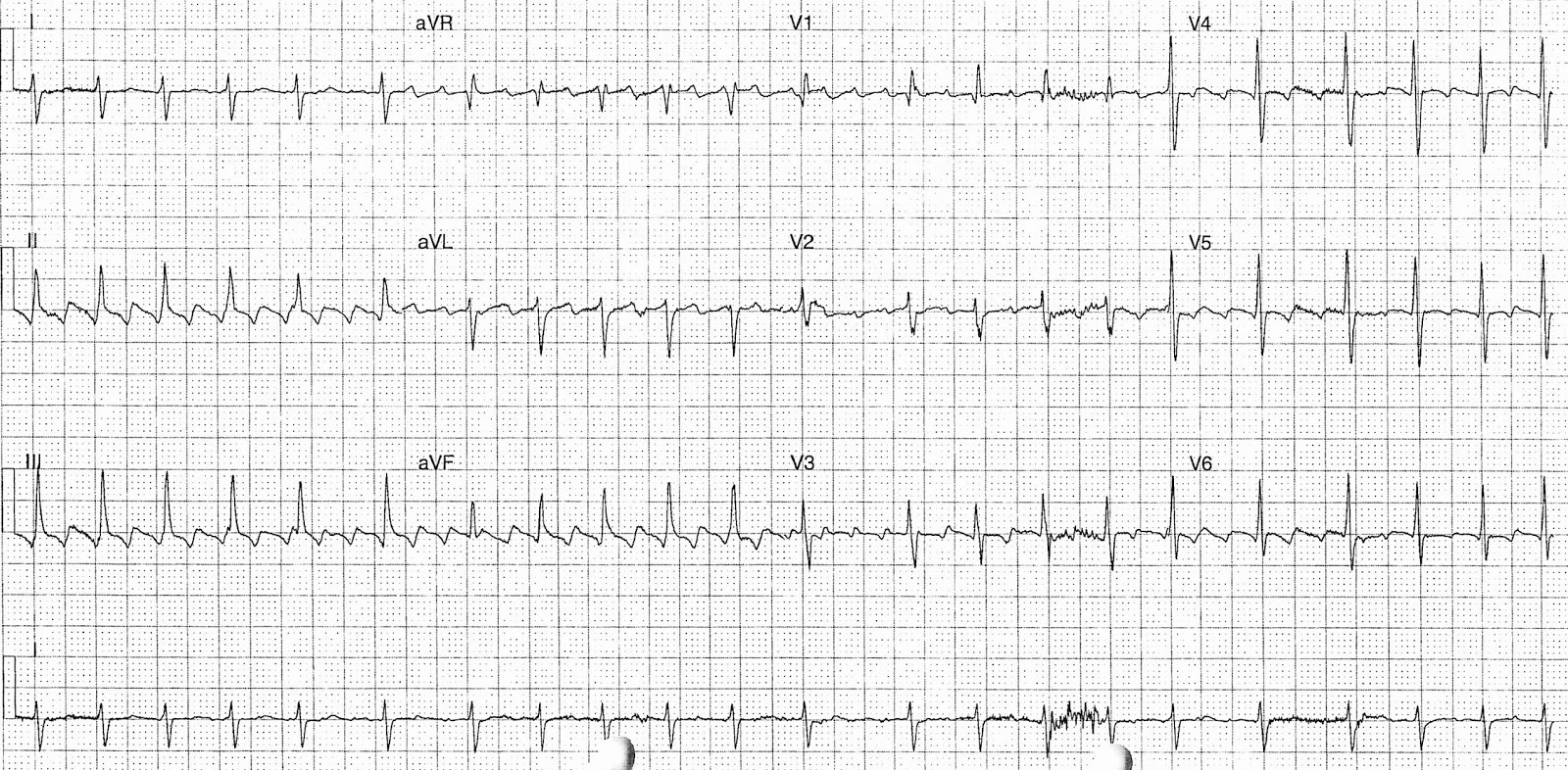 ECG of the Week: ECG of the Week - 30th May 2016 - Interpretation