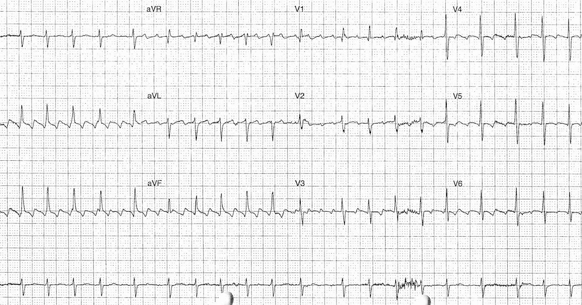 ECG of the Week: ECG of the Week - 30th May 2016 - Interpretation