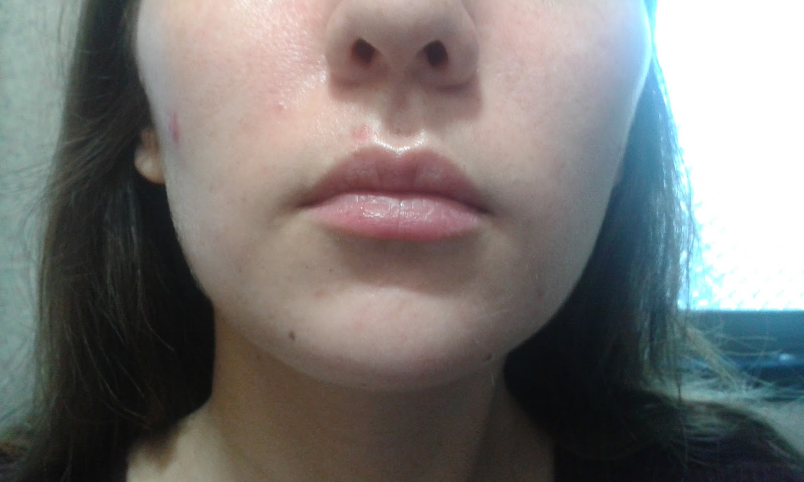 Blog de Asdfasdfasdfffffffff: 4/08/2014: Tratamiento para el acné 6° semana