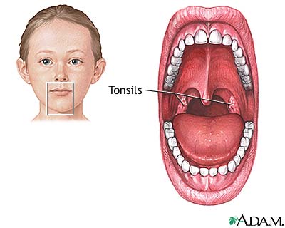 Nursing Care Plan Tonsillectomy