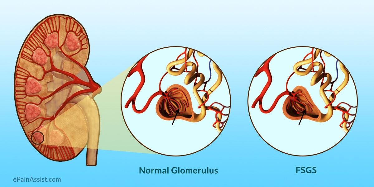 Renal-disease: Focal Segmental Glomerulosclerosis (FSGS) with ...