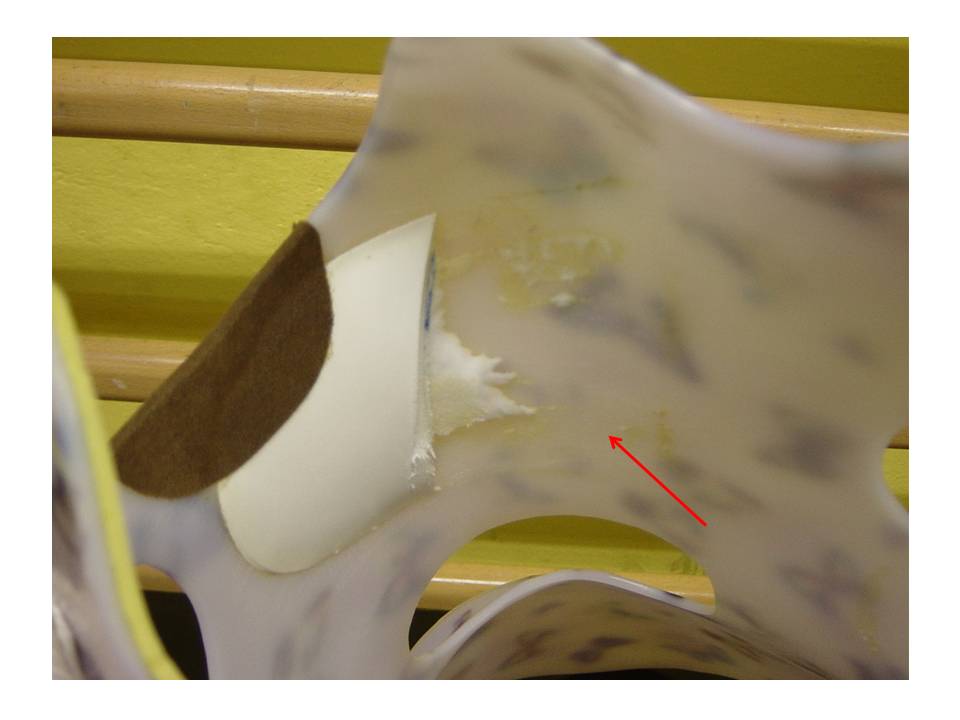 Despre corsetul Cheneau :: Corset scolioza / scoliosis braces