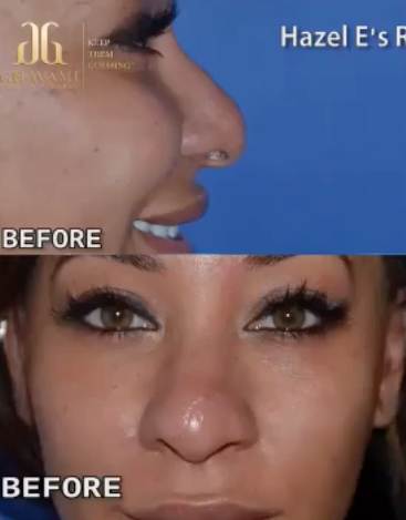 Reduced Hazel E Nose