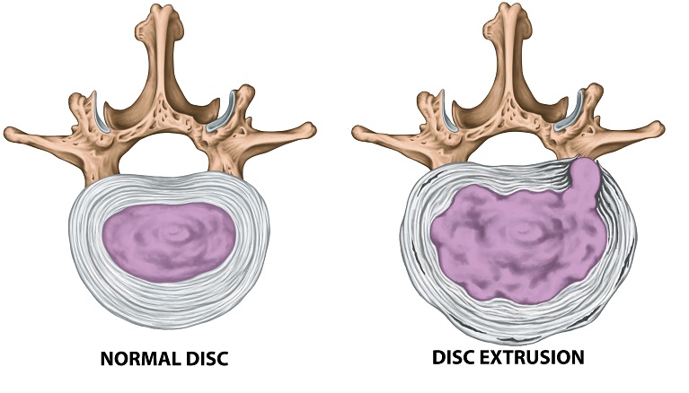 Intervertebral Disc Degeneration intervertebral-disc-degeneration