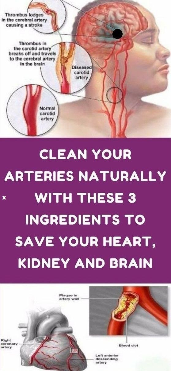 How to clean out plaque in arteries – 3 ingredients mixture - healhty ...
