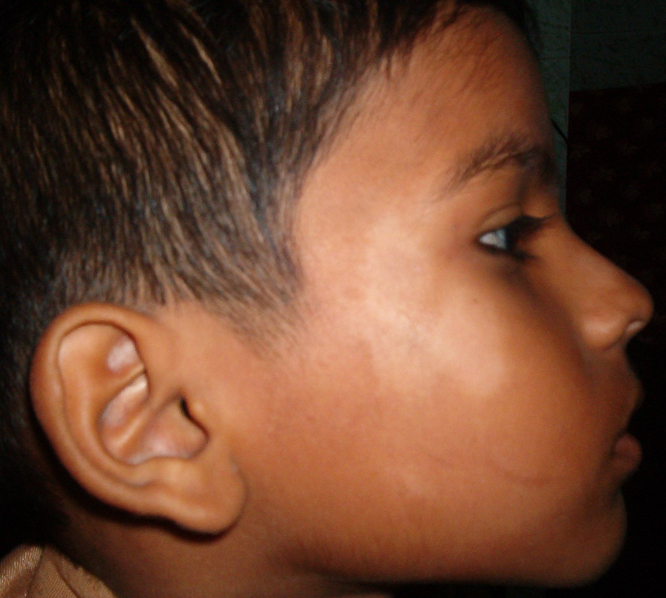 Pityriasis Alba, Bercak Putih namun Bukan Panu