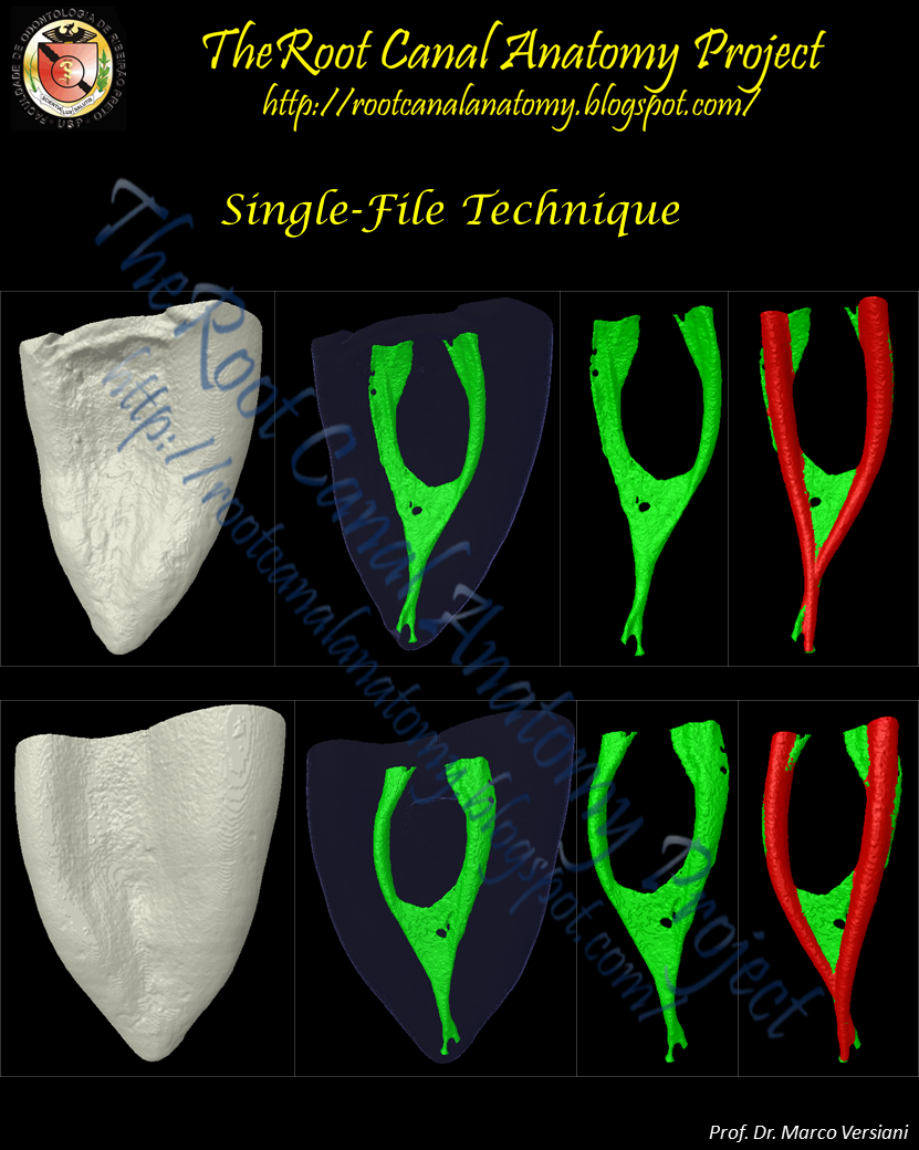 The Root Canal Anatomy Project: Single-File Technique Sample 1