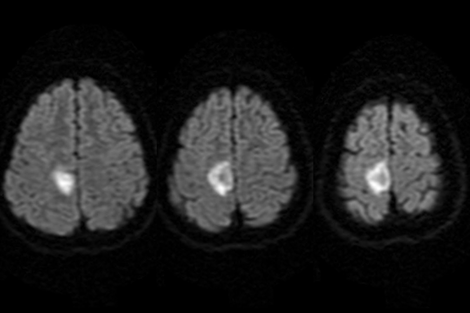 Dr Balaji Anvekar FRCR: Parietal lobe lesion on MRI