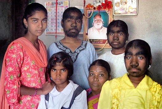 Three "Werewolf" Sisters from India : Suffering from Werewolf Syndrome ...