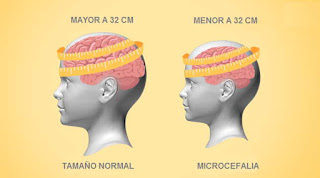 ¿La microcefalia que es?