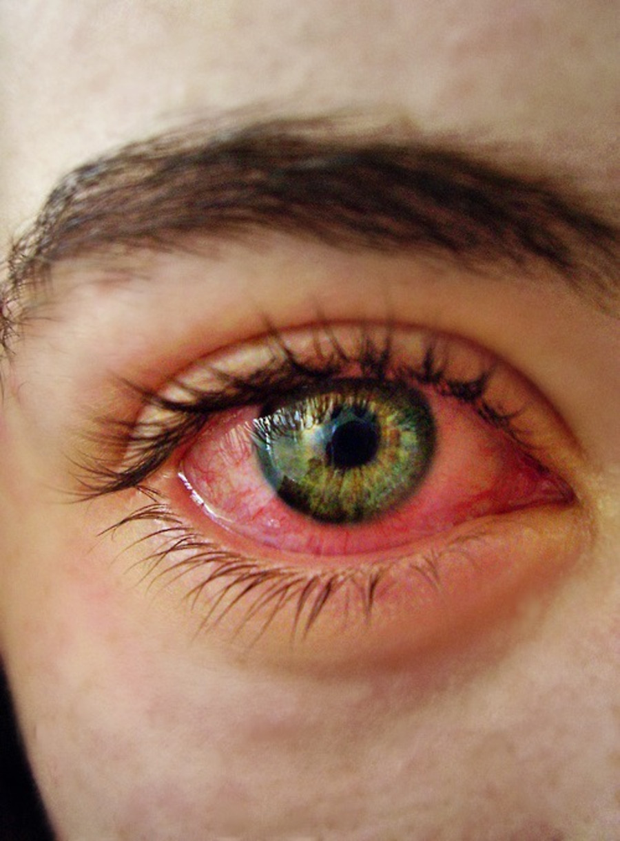 Informati, Italia: Perchè fumare Cannabis rende gli occhi rossi?