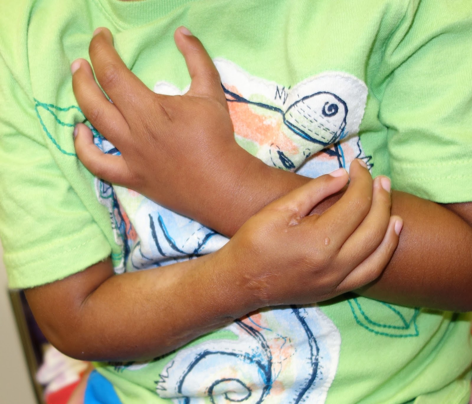 Even More Thoughts on Pollicization | Congenital Hand and Arm ...