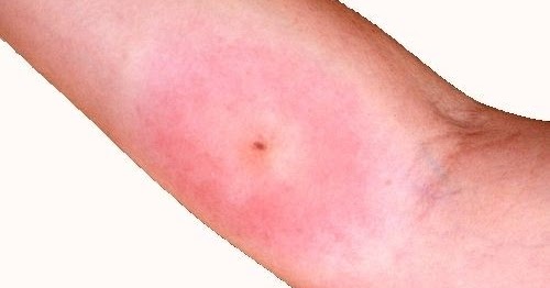 ER goldbook: Arthropod bites and stings