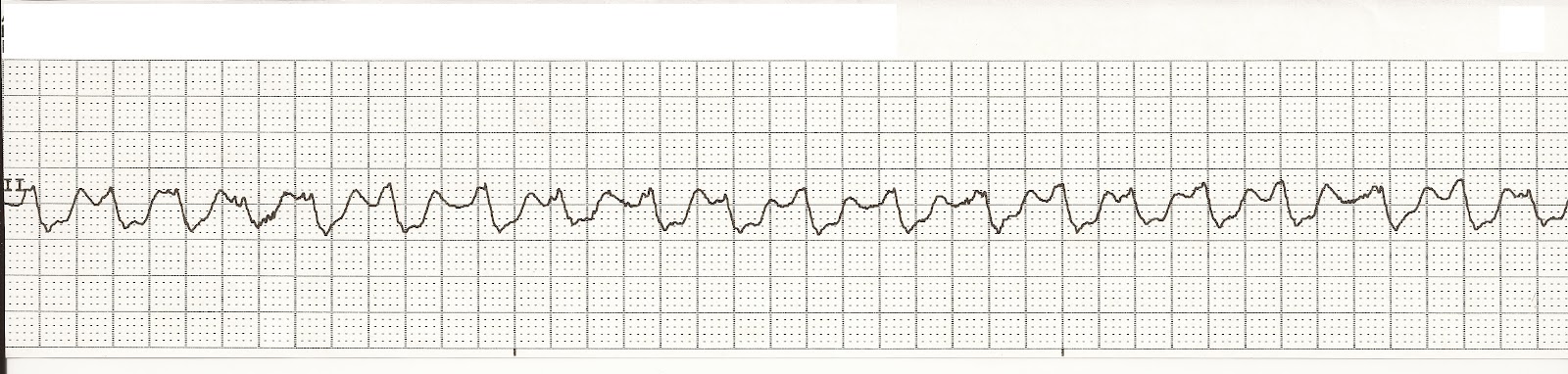 Pediatric Advance Life Support: SVT Part 3