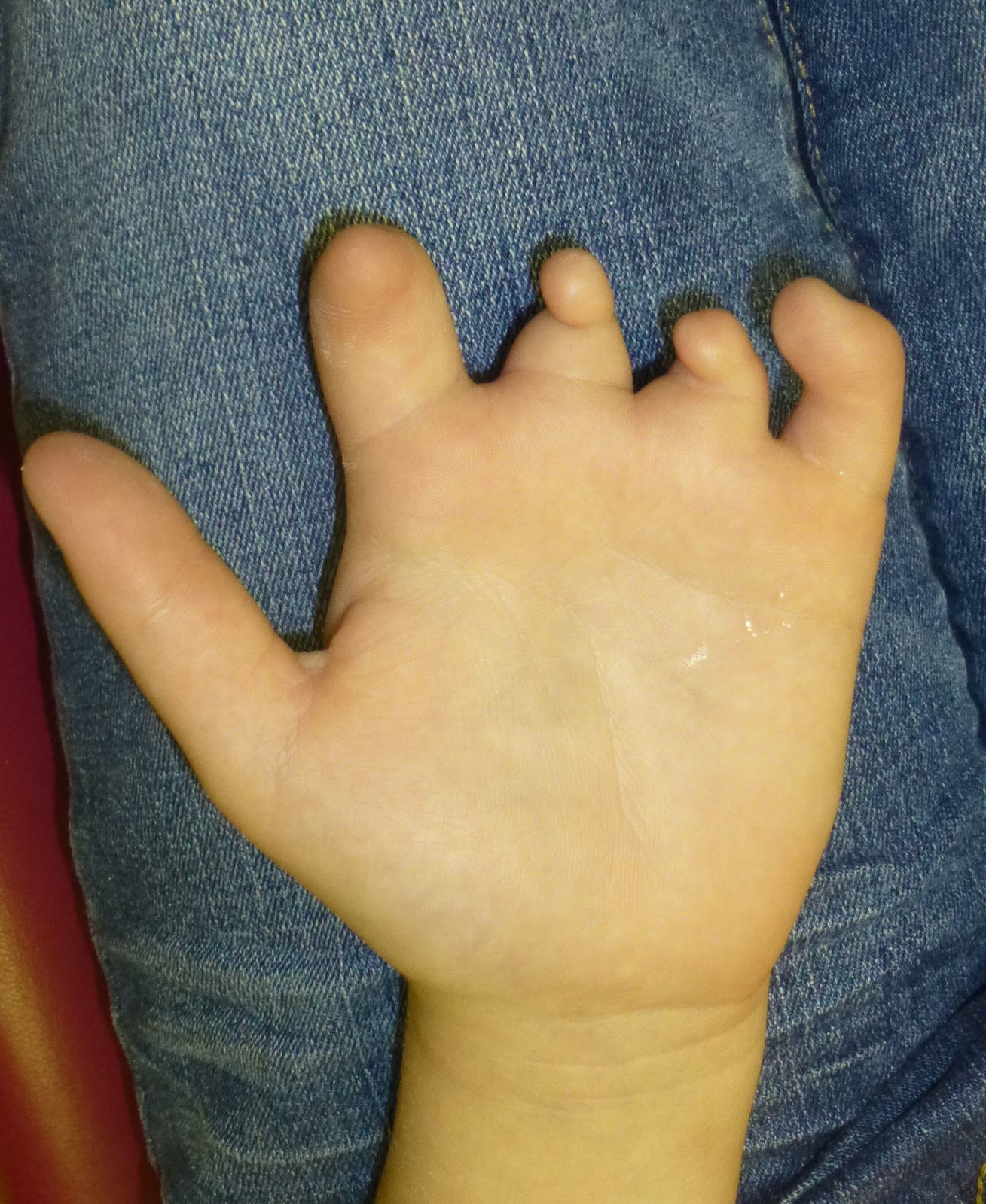 Toe Transfers | Congenital Hand and Arm Differences | Washington ...