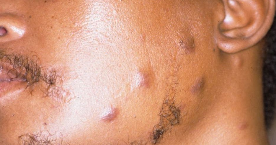 916SKIN - ACNE SKIN & WELLNESS CLINIC: WHAT IS NODULAR ACNE...