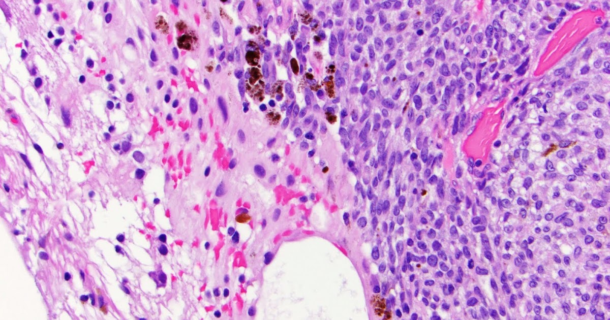 neuropathology blog: Uveal Melanoma: The Basics