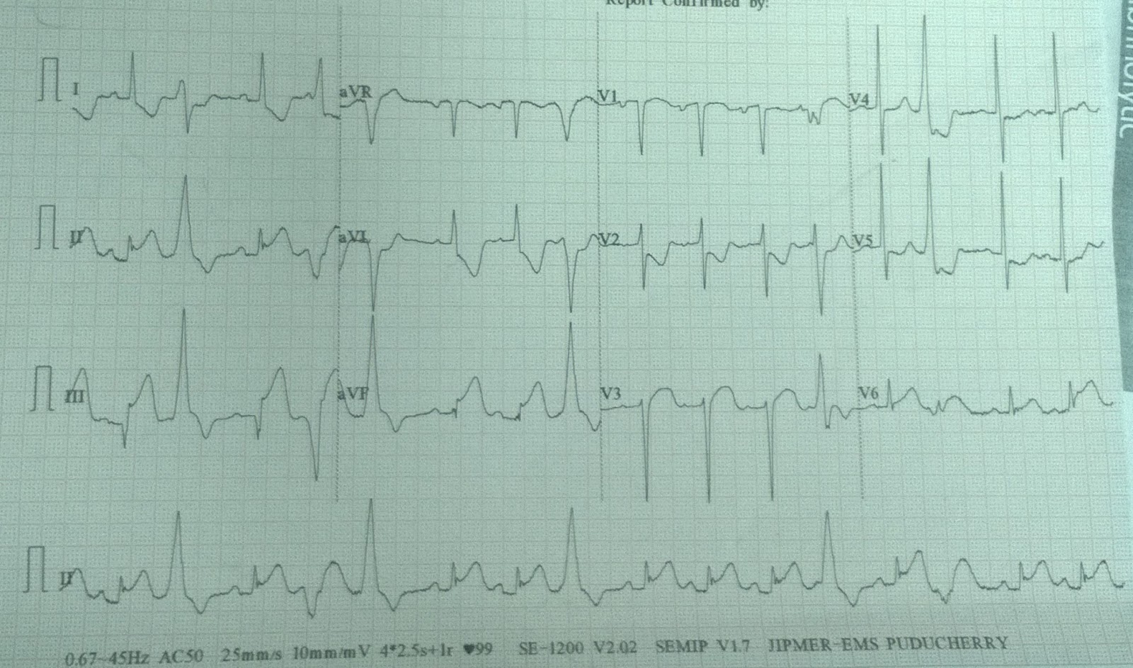 Cardiology window: Inferior wall myocardial infarction with right sided ...