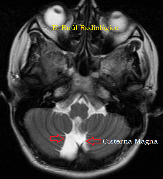 КСС. Череп. Sinus Pericranii. Идиопатический внутричерепной гиперостоз ...