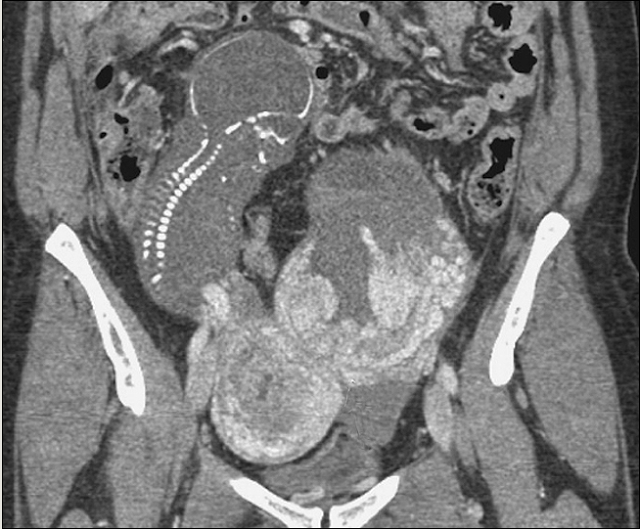 Embarazo abdominal