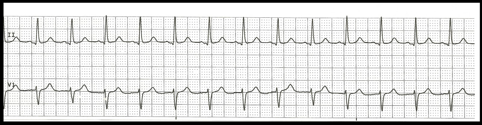 EKG Rhythm Strip Quiz 84