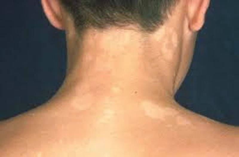 Penyebab munculnya penyakit panu, ciri-ciri, cara mengatasinya, dan ...