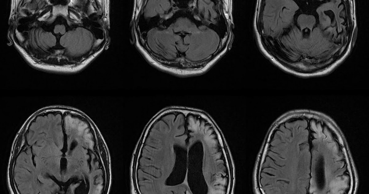 Dr Balaji Anvekar FRCR: Crossed cerebellar diaschisis