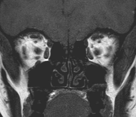 Inferior Rectus Anomalies-MRI - Radiology Imaging