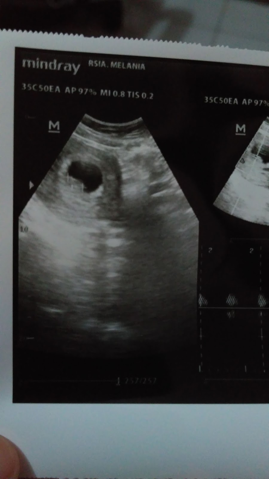 kebersamaan kami: Saat usia kehamilan pertamaku di umur 10 minggu